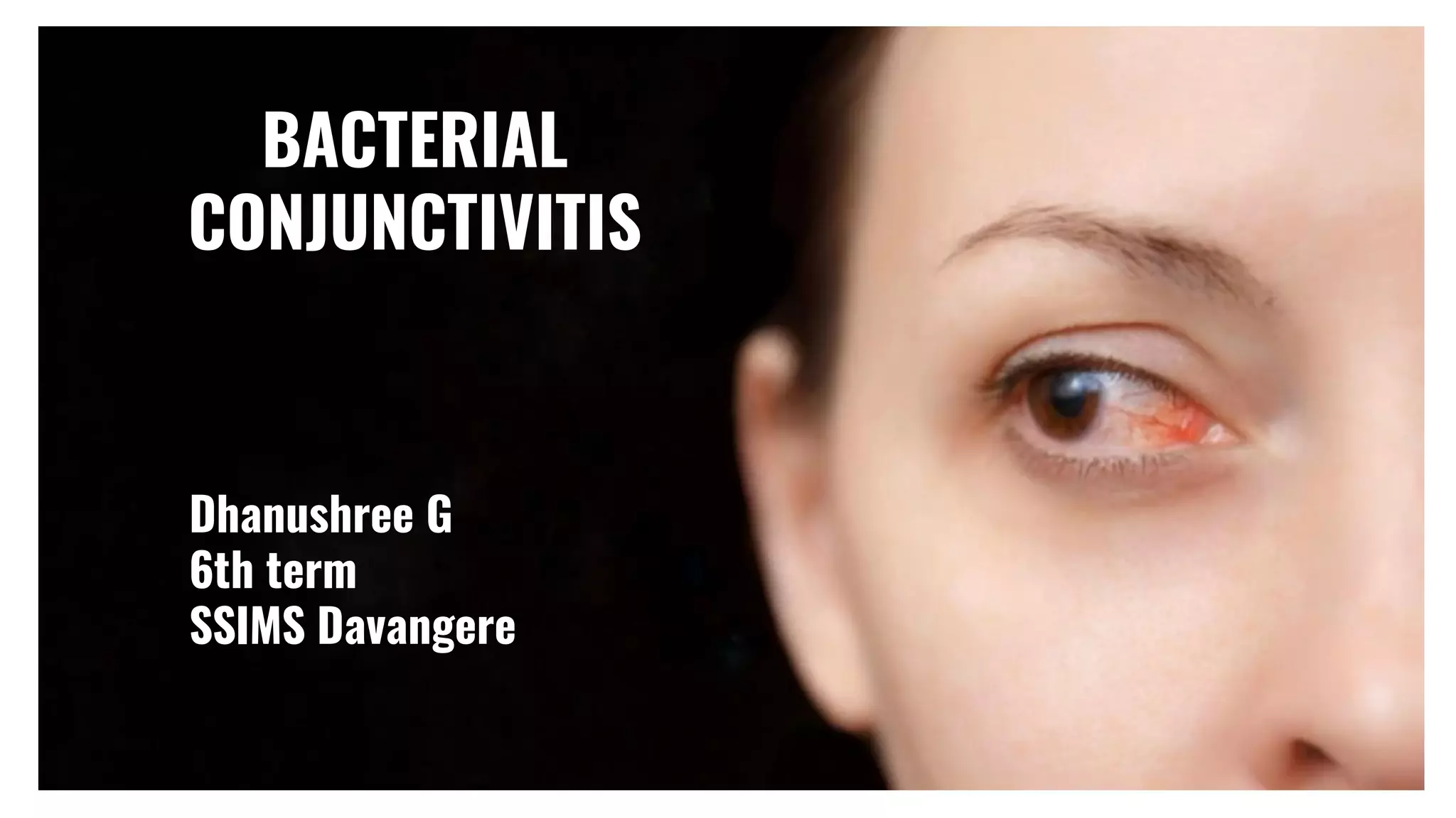 Bacterial conjunctivitis Ophthalmology | PDF