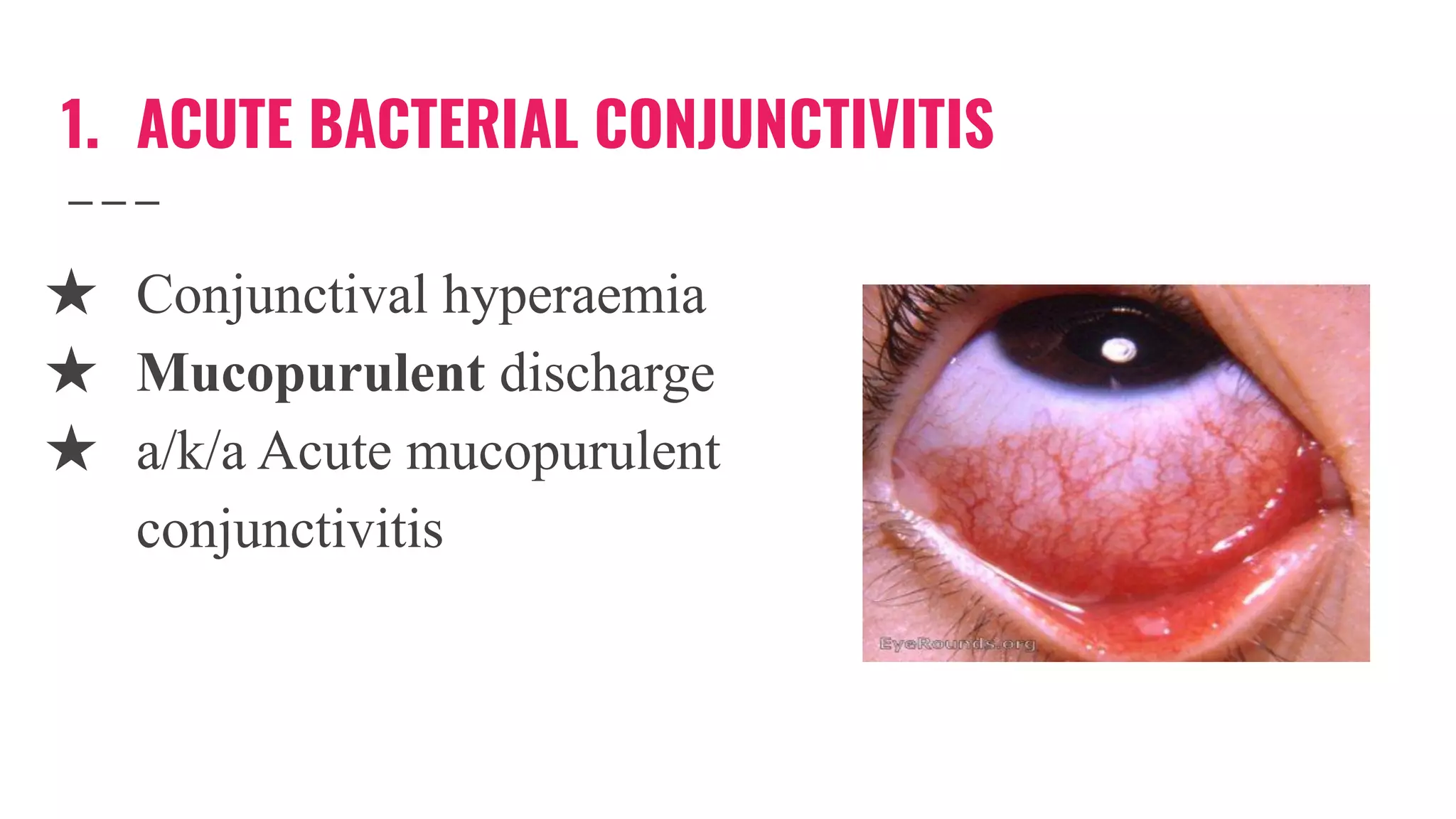 Bacterial conjunctivitis Ophthalmology | PDF