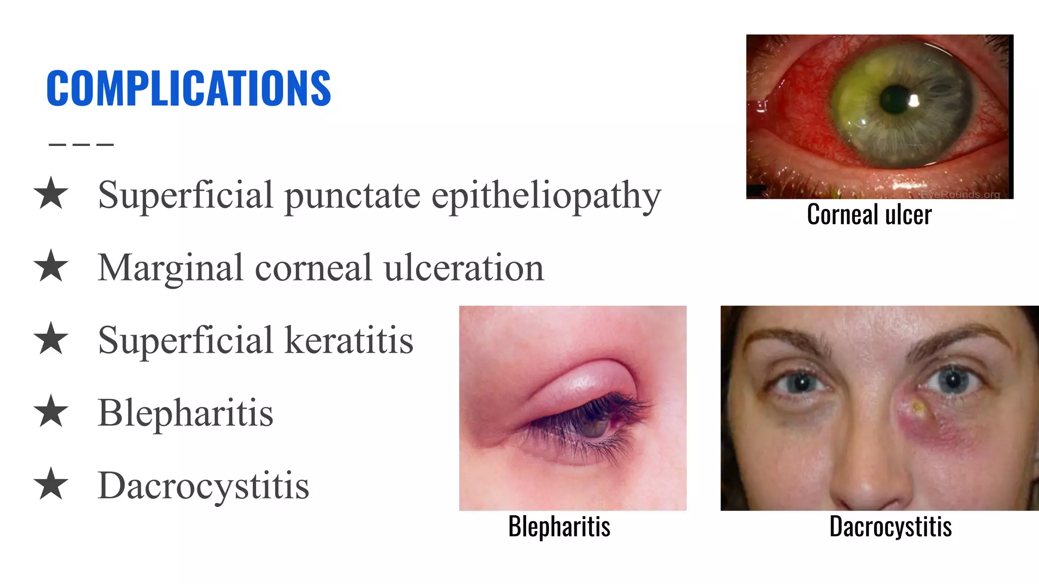 Bacterial conjunctivitis Ophthalmology | PDF