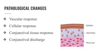 Bacterial conjunctivitis Ophthalmology | PDF
