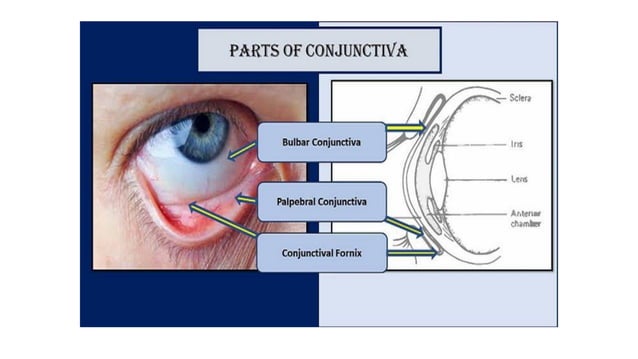 Bacterial conjunctivitis Ophthalmology | PDF