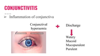 Bacterial conjunctivitis Ophthalmology | PDF