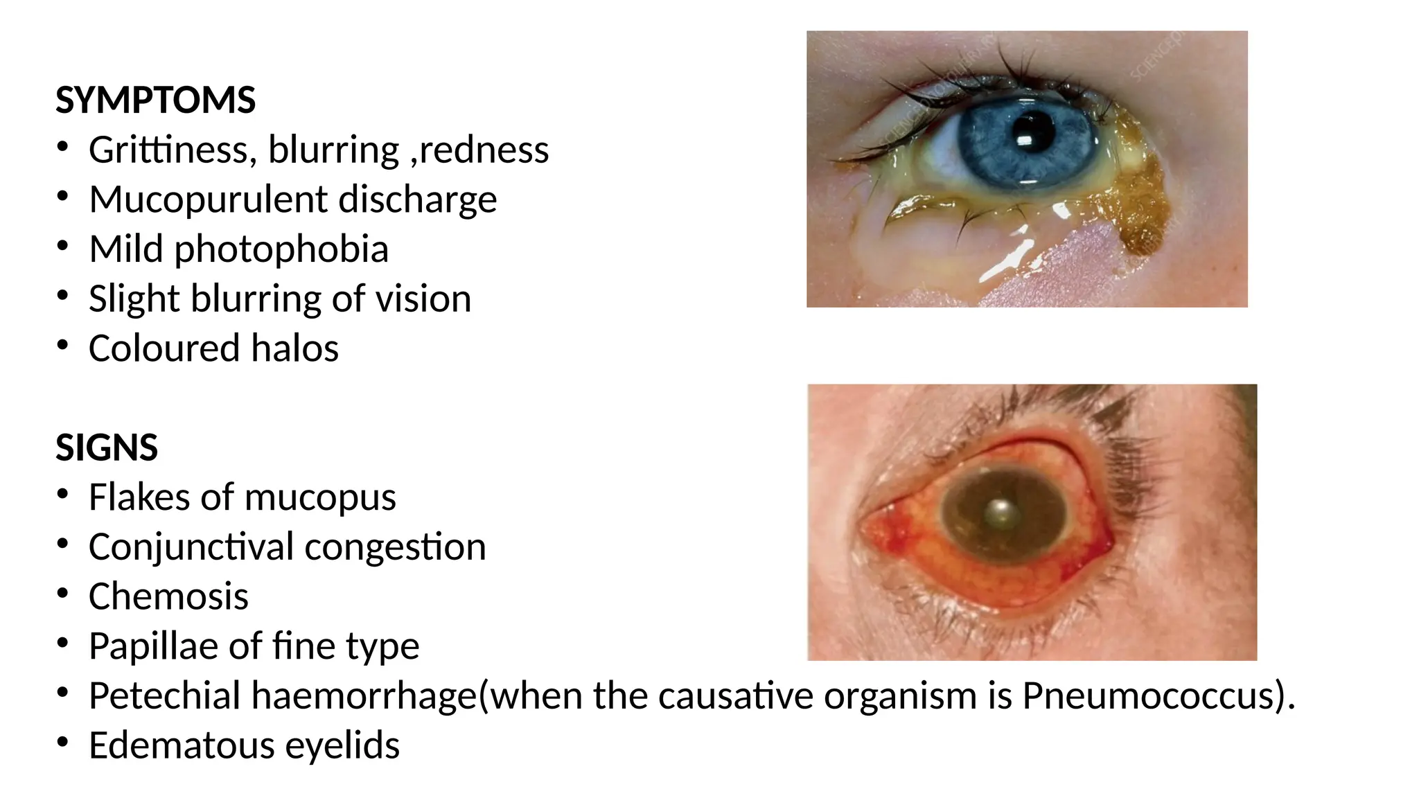 bacterial conjunctivitis.pptx jjjjjjjjjjjjjjjjjjjjjjjjjjjjjjjjjjjjjjj | PPTX