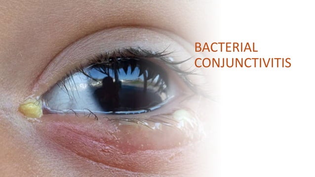 BACTERIAL CONJUNCTIVITIS for BSc Optometry | PPTX