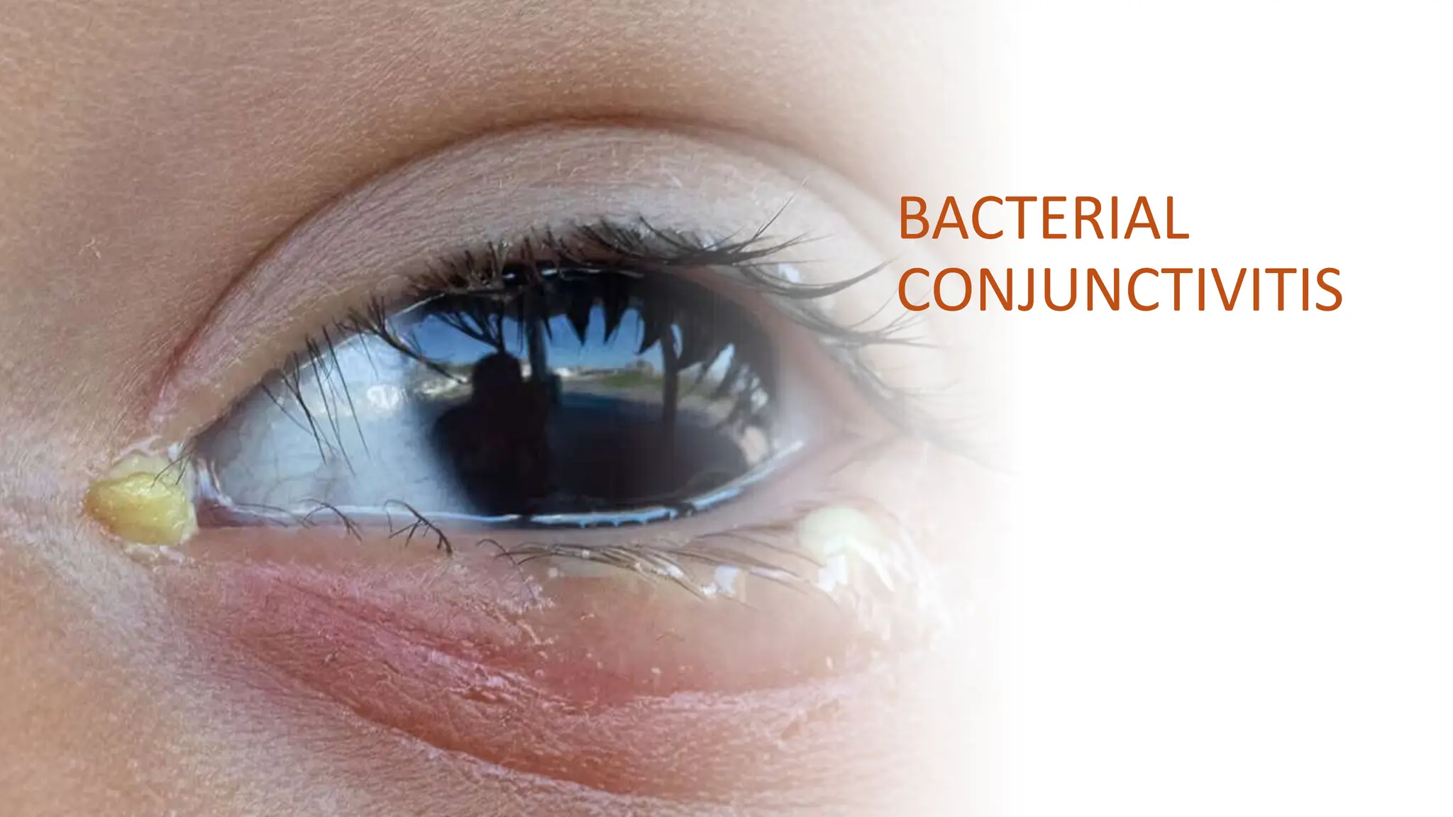 Bacterialconjunctivitis Ocular Microbiology Ppt