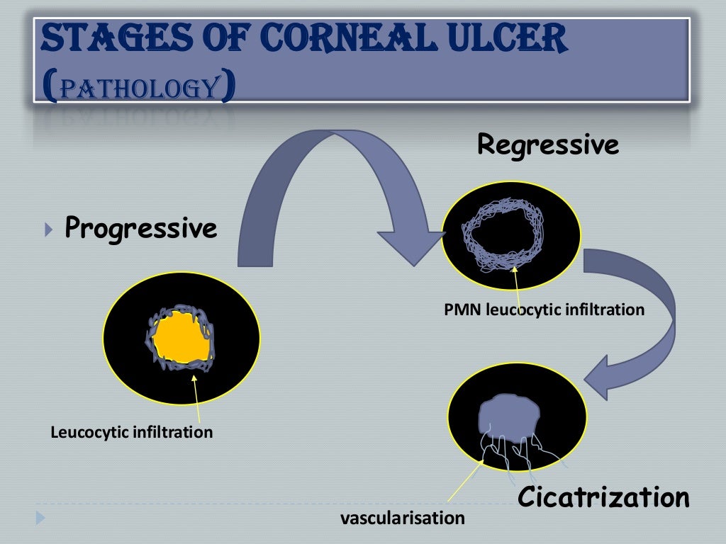 Bacterial corneal ulcer (pathogenesis, pathology, clinical features).