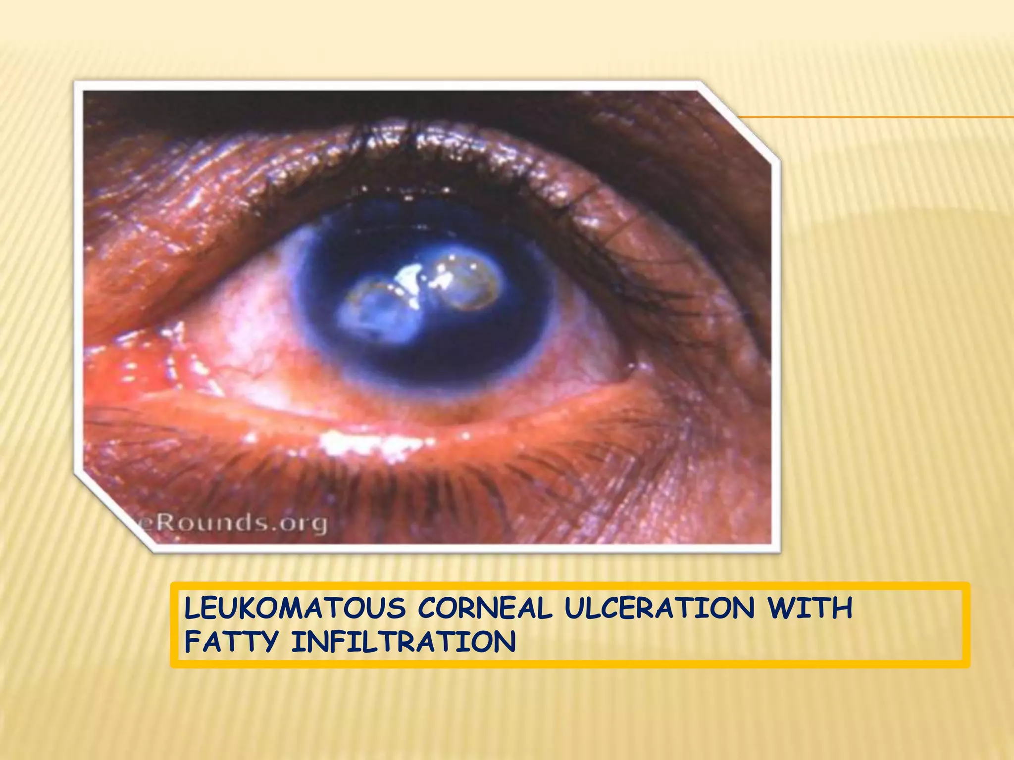 Bacterial corneal ulcer (Etilogy, pathogenesis, pathology & clinical ...