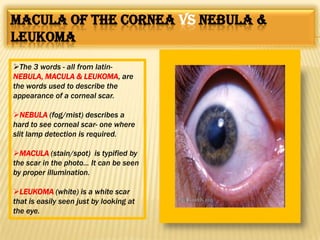 Bacterial corneal ulcer (Etilogy, pathogenesis, pathology & clinical ...
