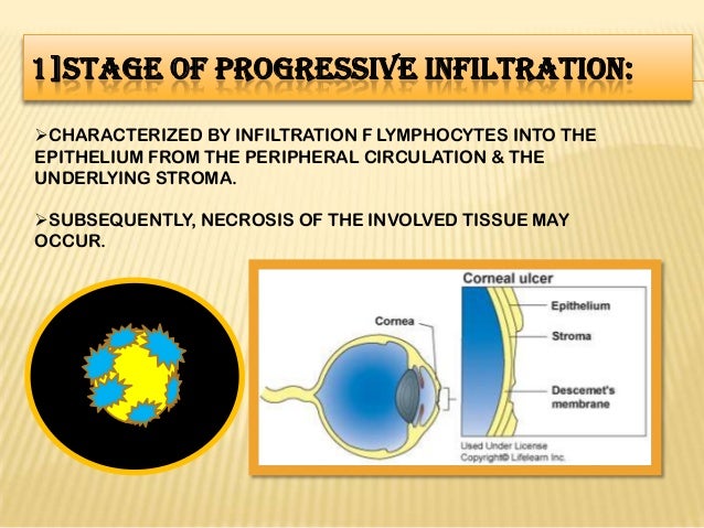 Bacterial corneal ulcer (Etilogy, pathogenesis, pathology & clinical