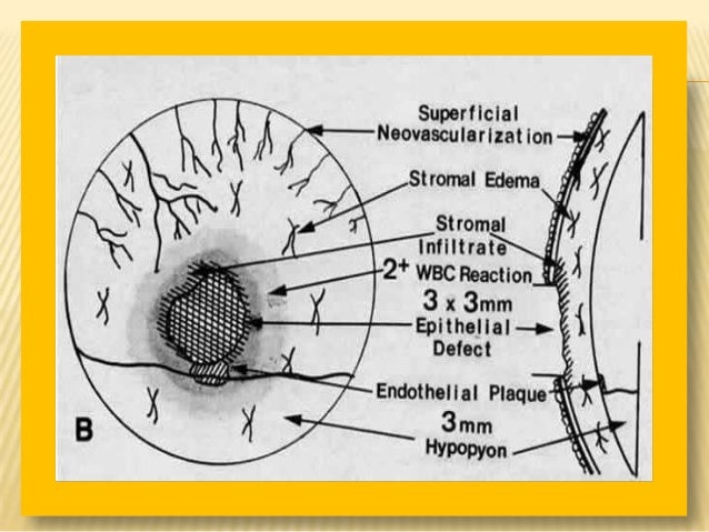 Bacterial corneal ulcer (Etilogy, pathogenesis, pathology & clinical