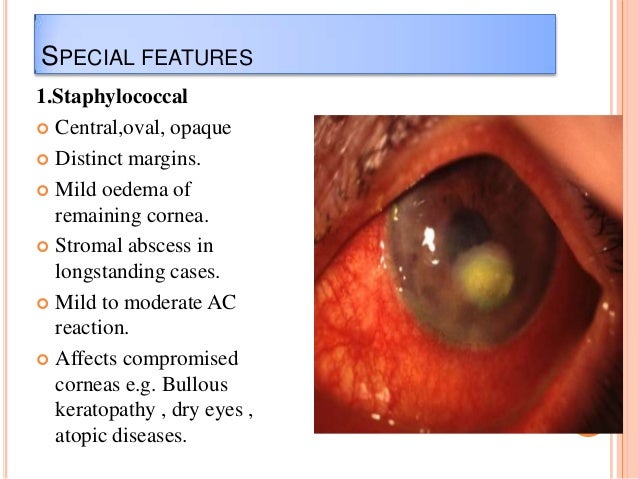 Bacterial corneal ulcer DrBP