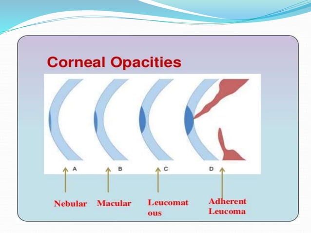 Bacterial Corneal Ulcer Pptx