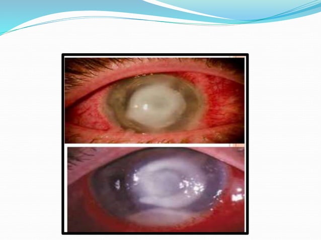 Bacterial Corneal Ulcer Pptx