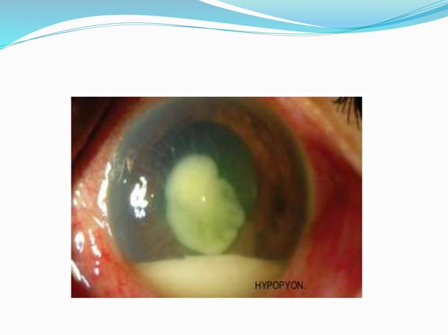 Bacterial Corneal Ulcer Pptx