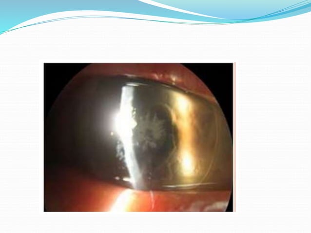 Bacterial Corneal Ulcer Pptx