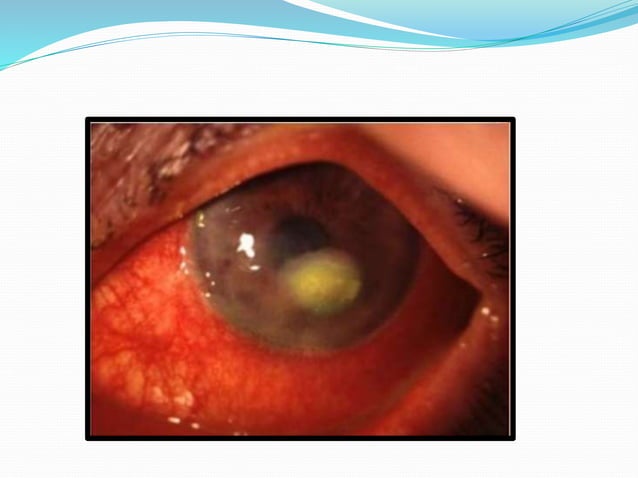 Bacterial corneal ulcer | PPTX