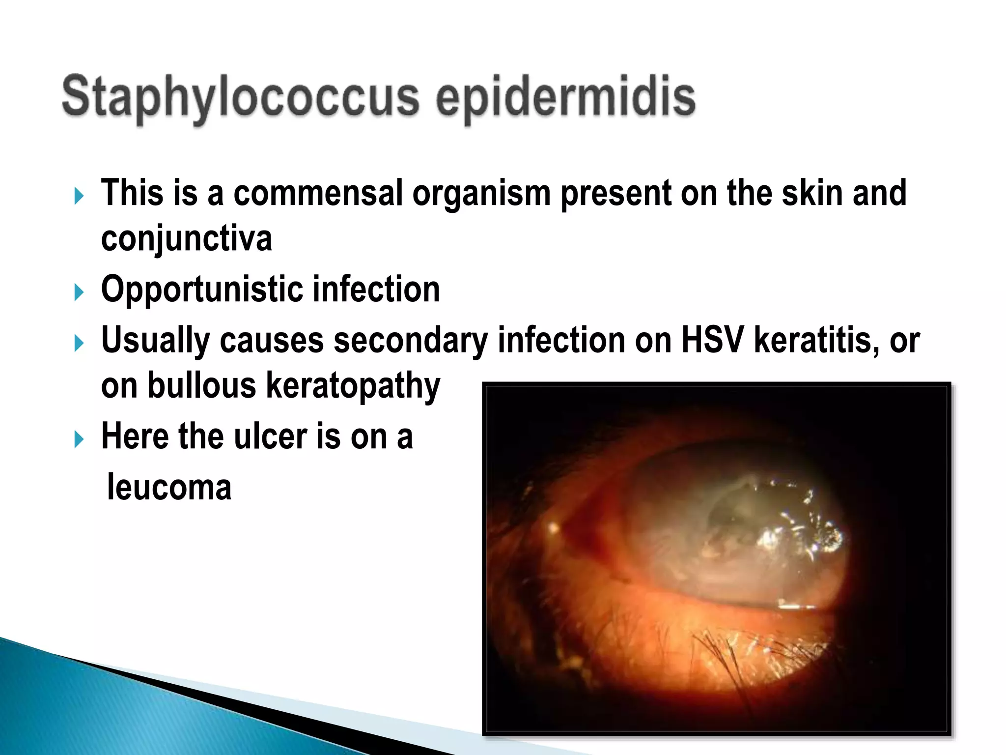 Bacterial corneal ulcer | PPTX