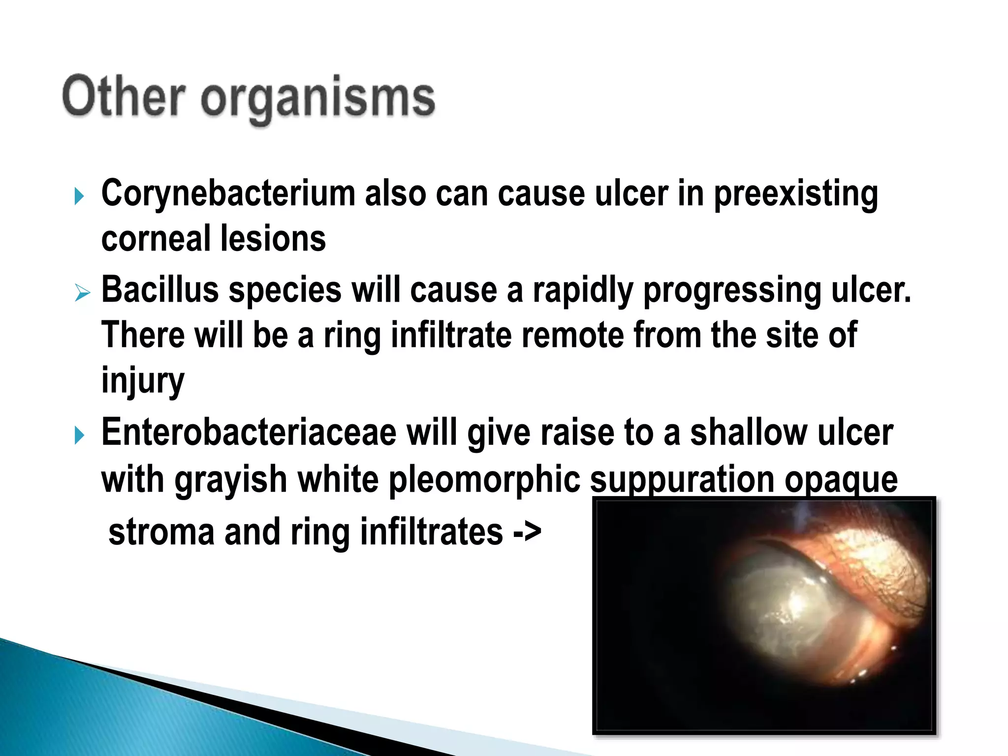 Bacterial corneal ulcer | PPTX