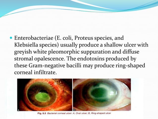Bacterial corneal ulcer | PPT