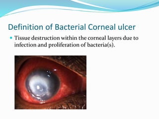 Bacterial corneal ulcer | PPTX
