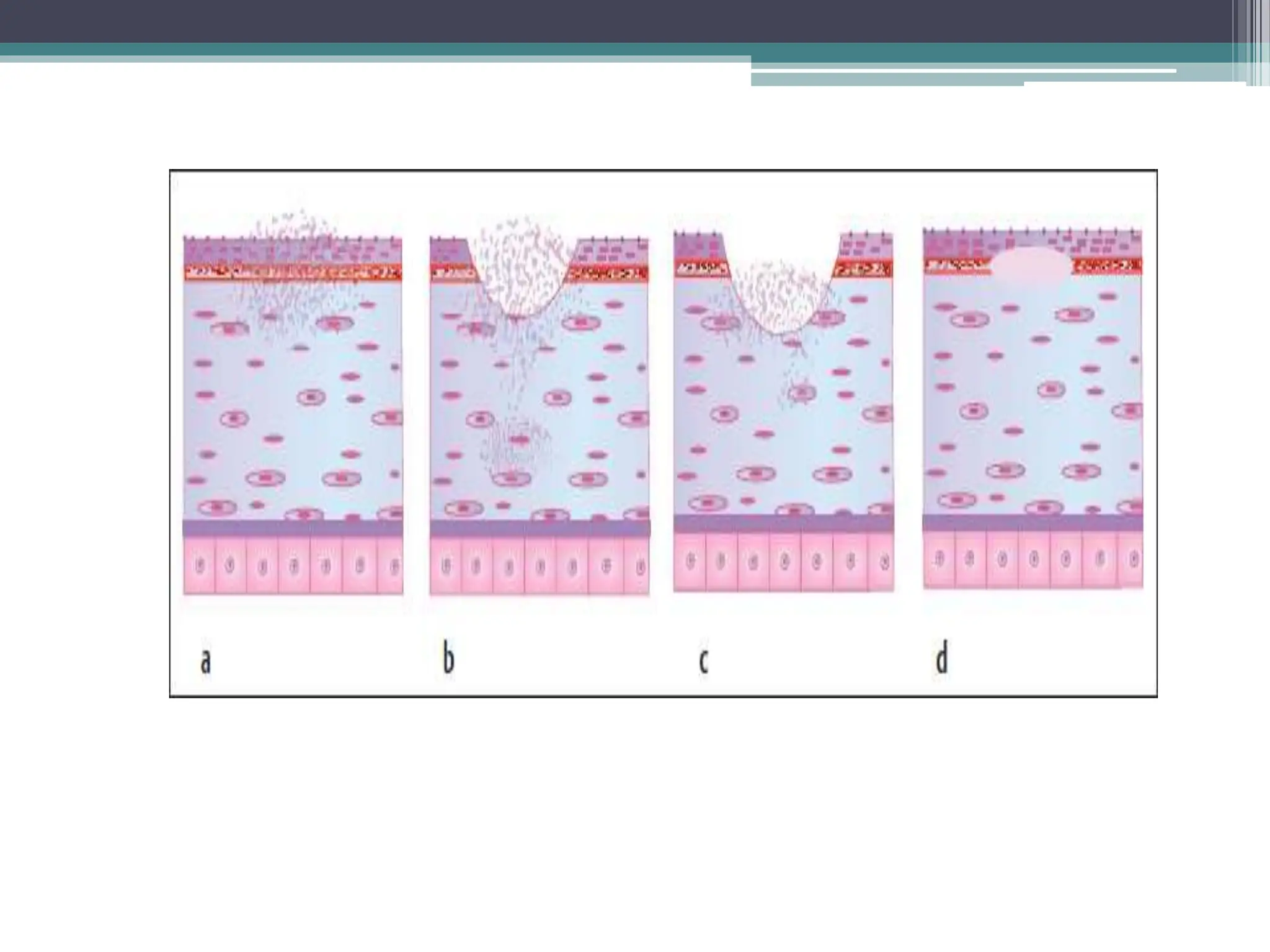 Bacterial Corneal Ulcer 2 Pptx Cornea Pptx