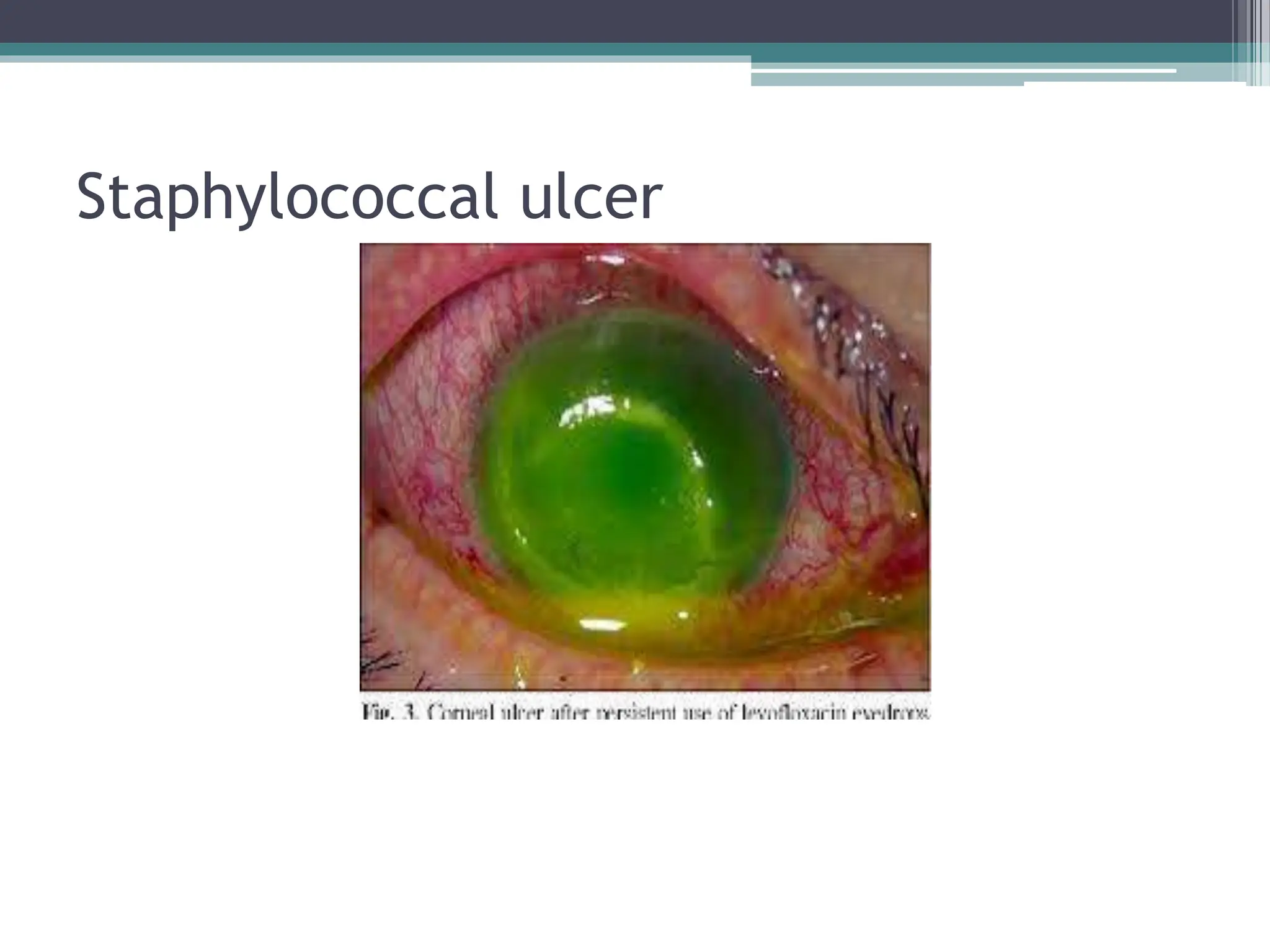 Bacterial Corneal Ulcer 2 Pptx Cornea Pptx