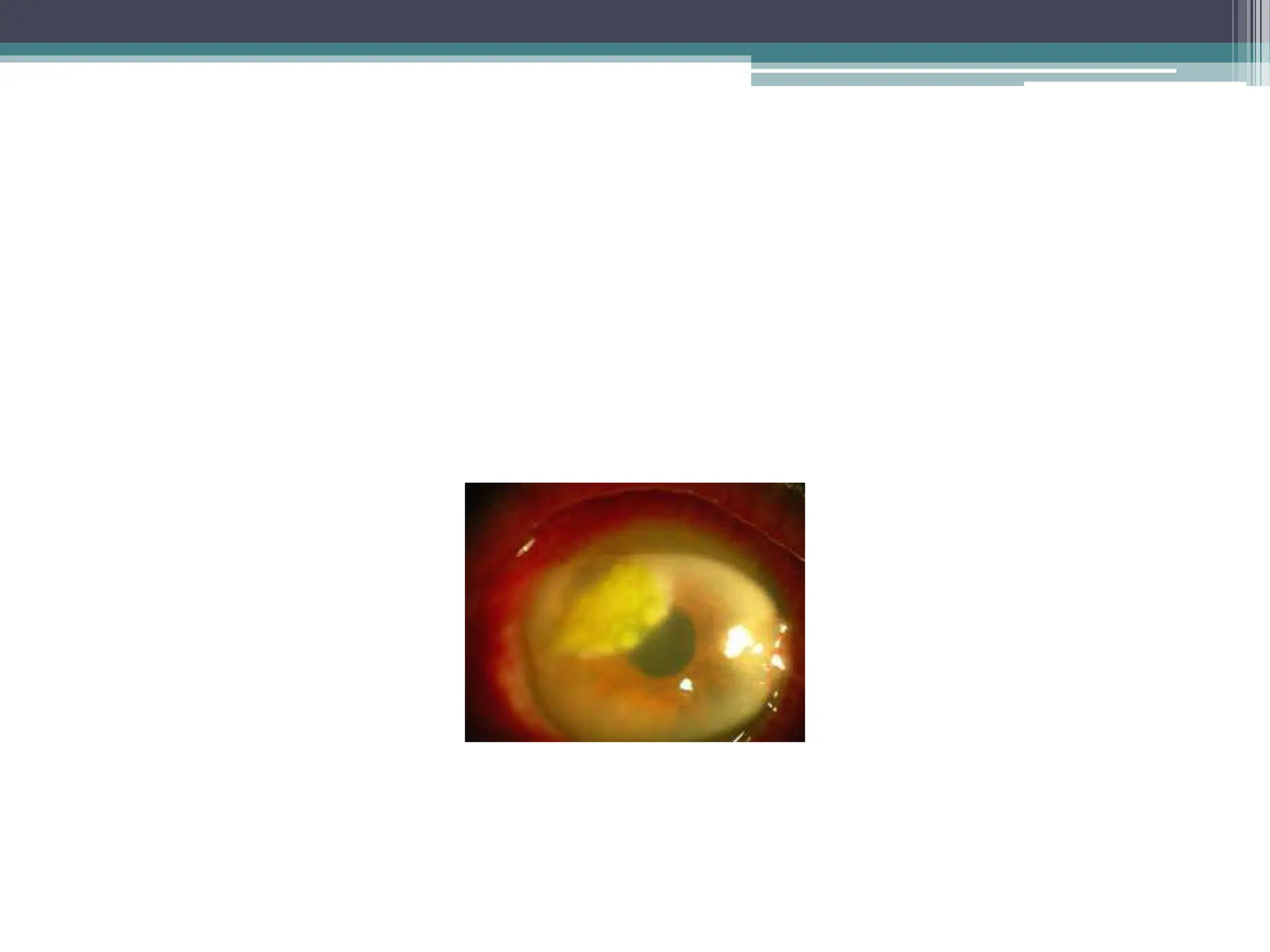 Bacterial Corneal Ulcer 2 Pptx Cornea Pptx
