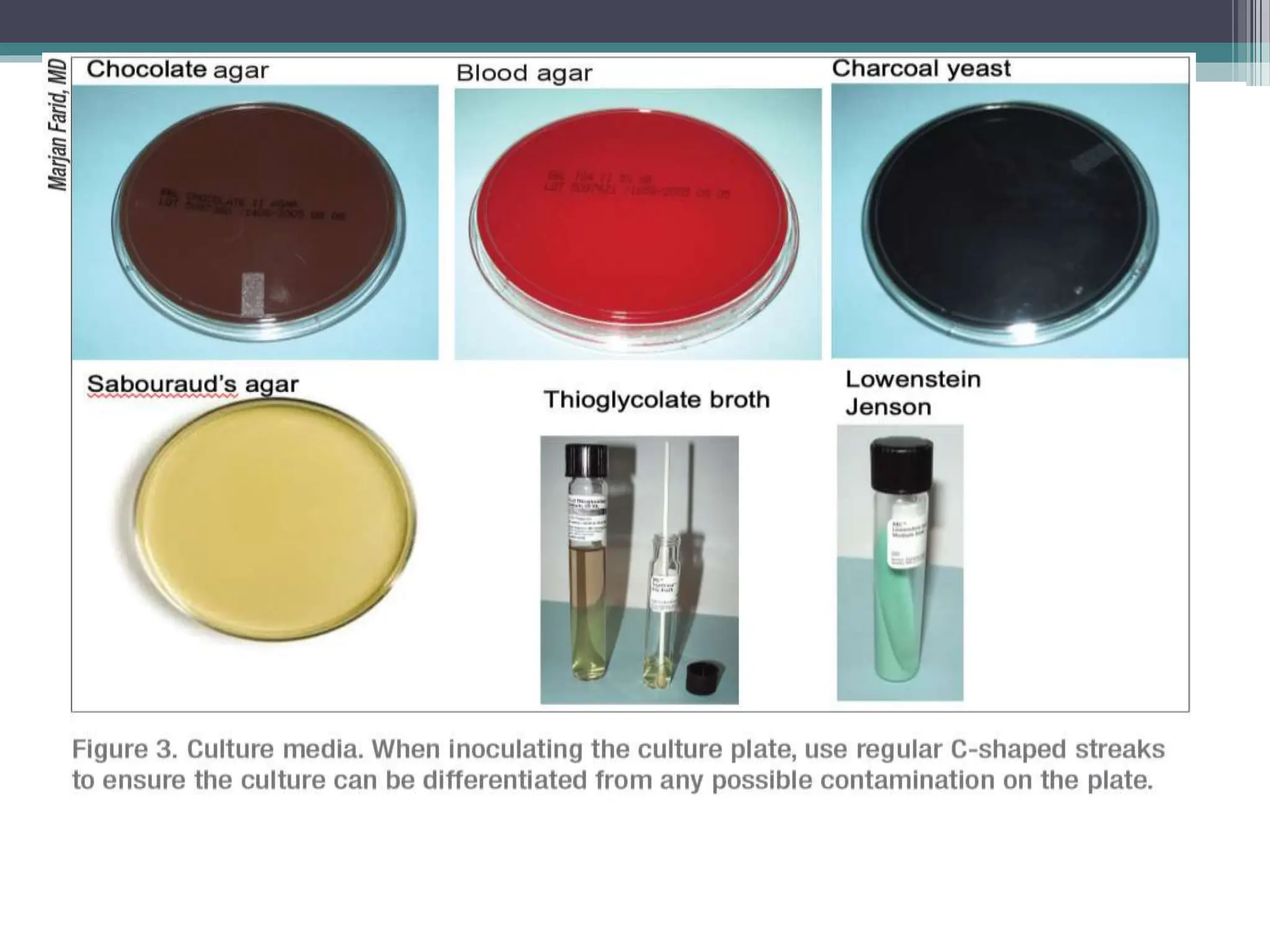Bacterial Corneal Ulcer 2 Pptx Cornea Pptx