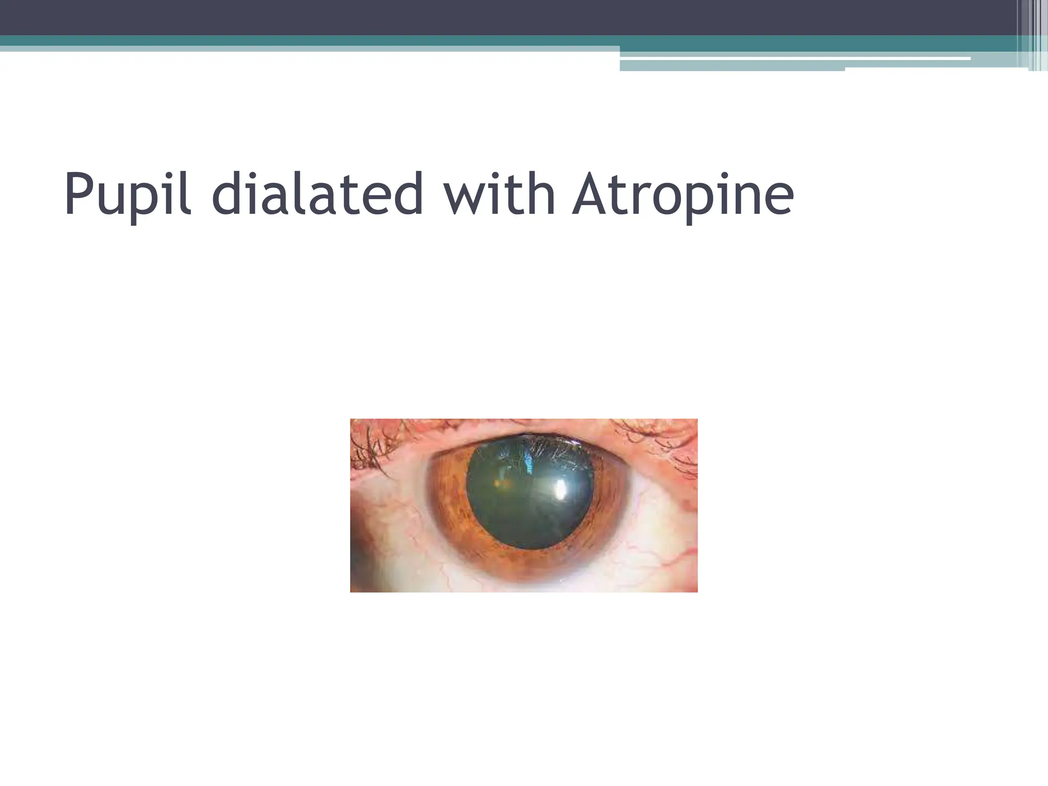 Bacterial Corneal Ulcer 2 Pptx Cornea Pptx