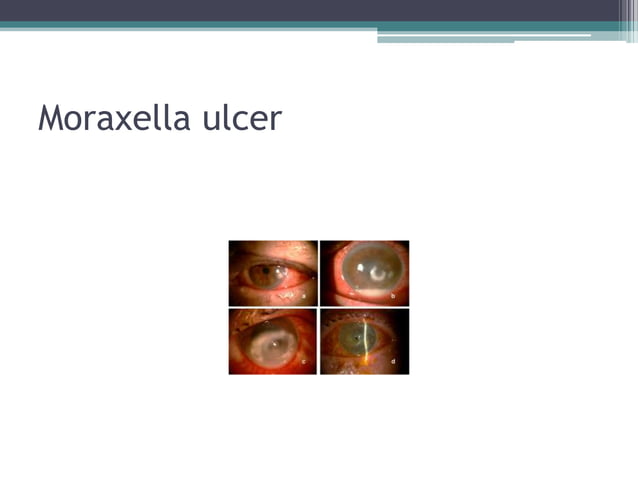Bacterial corneal ulcer (2).pptx CORNEA | PPT