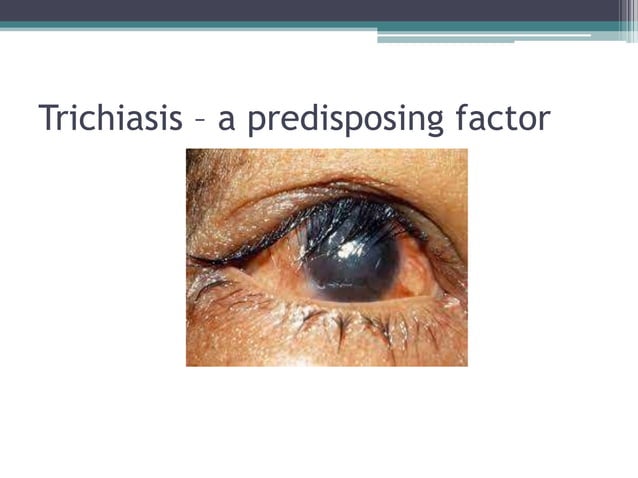 Bacterial Corneal Ulcer 2 Pptx Cornea Ppt