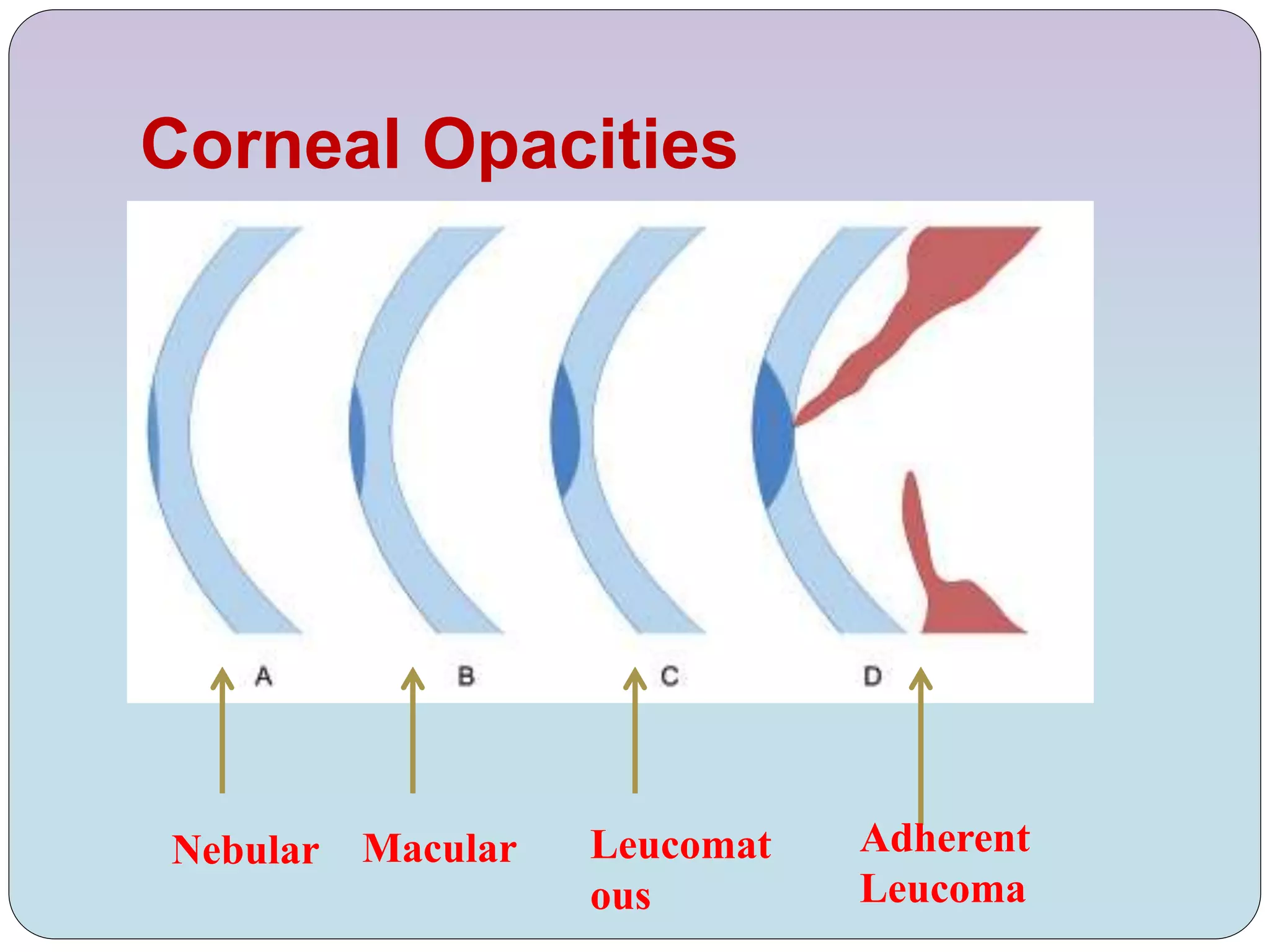Bacterial corneal ulcer | PPTX