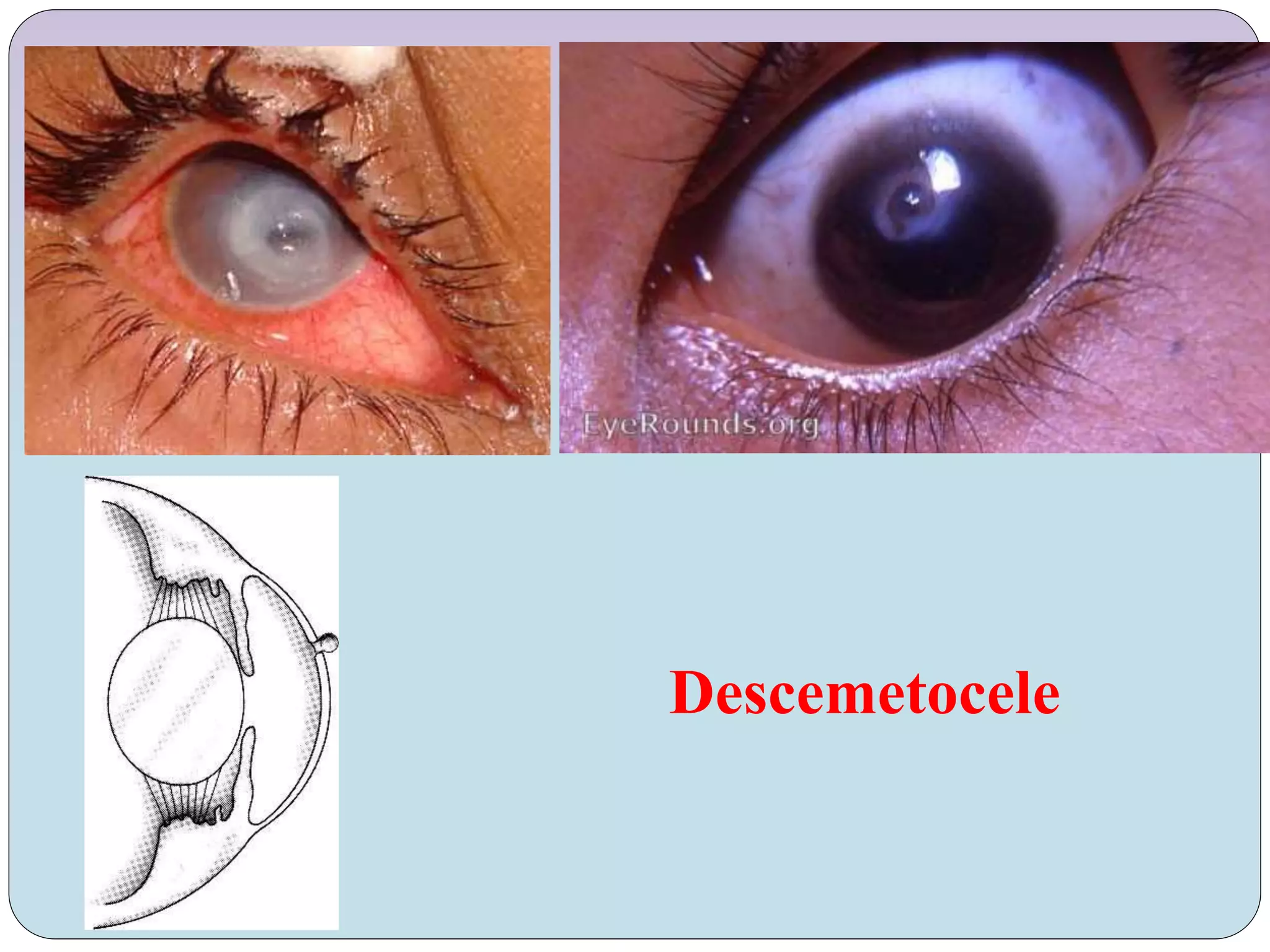 Bacterial corneal ulcer | PPTX