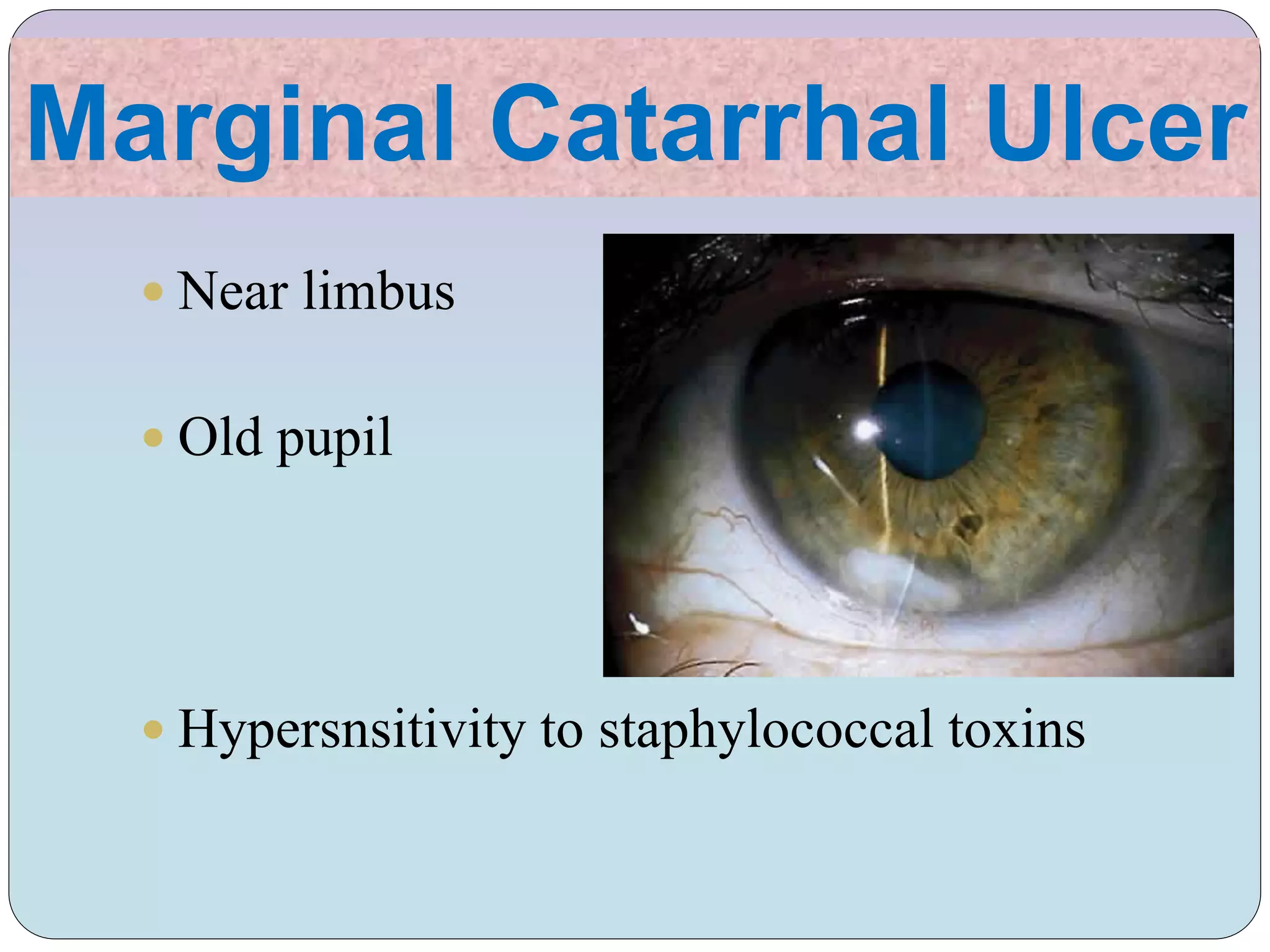 Bacterial corneal ulcer | PPTX
