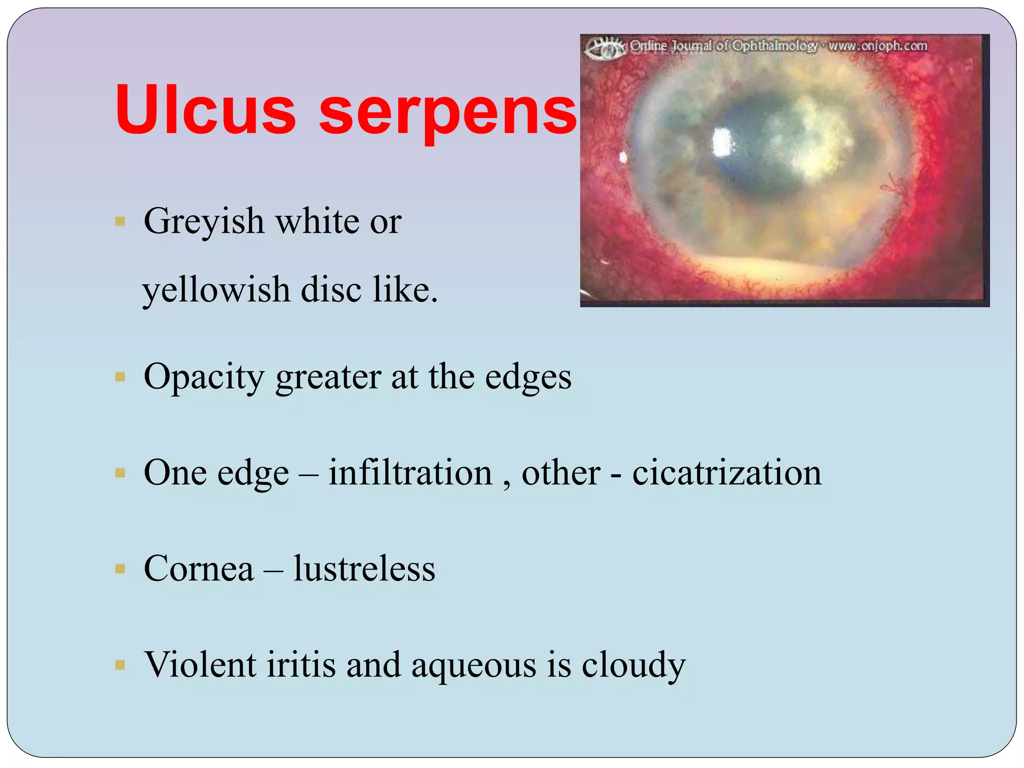 Bacterial corneal ulcer | PPTX