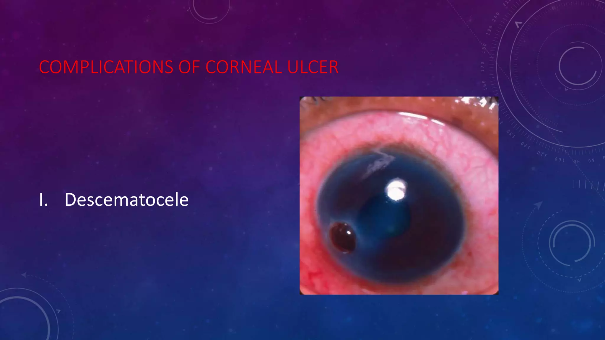 Bacterial corneal ulcers.pptx