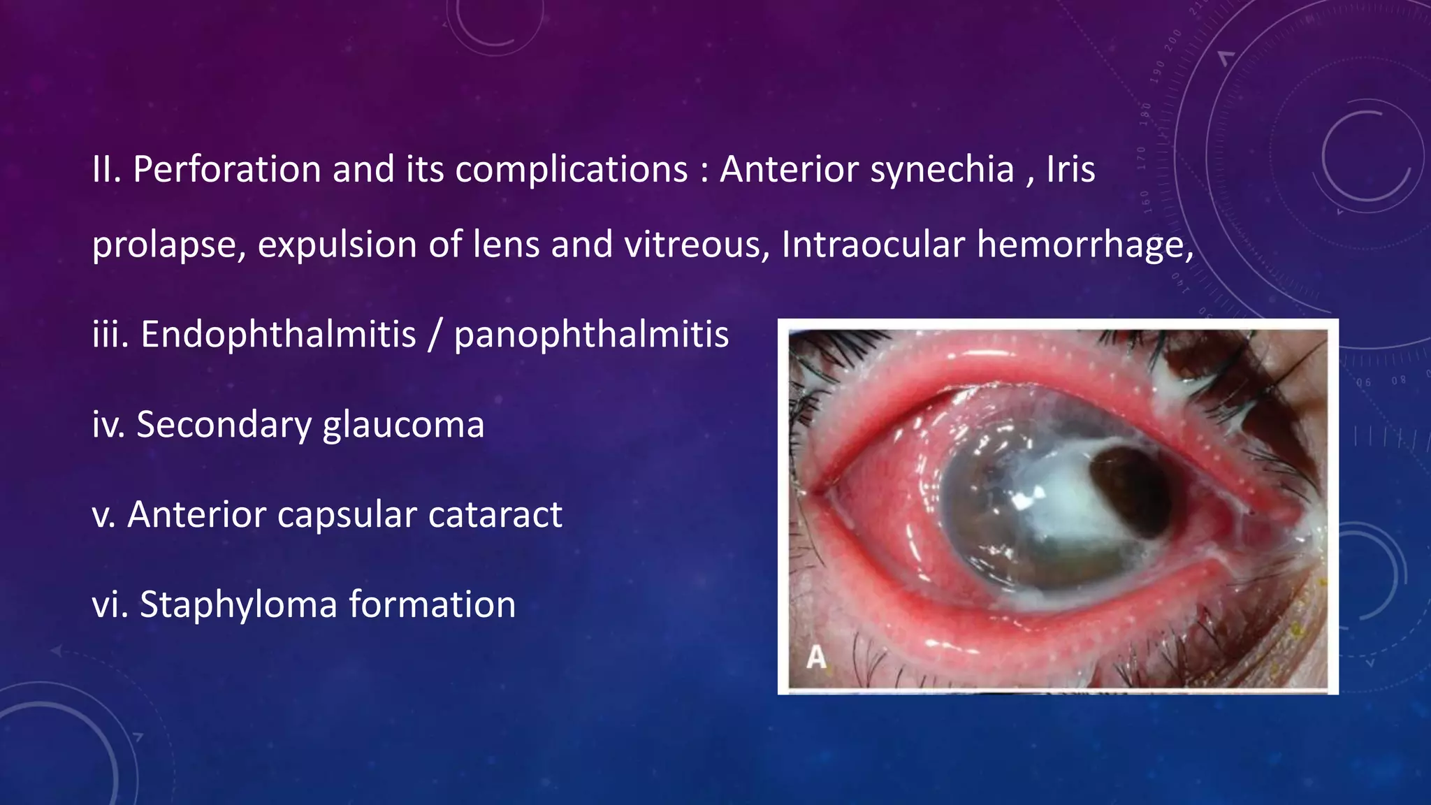 Bacterial corneal ulcers.pptx