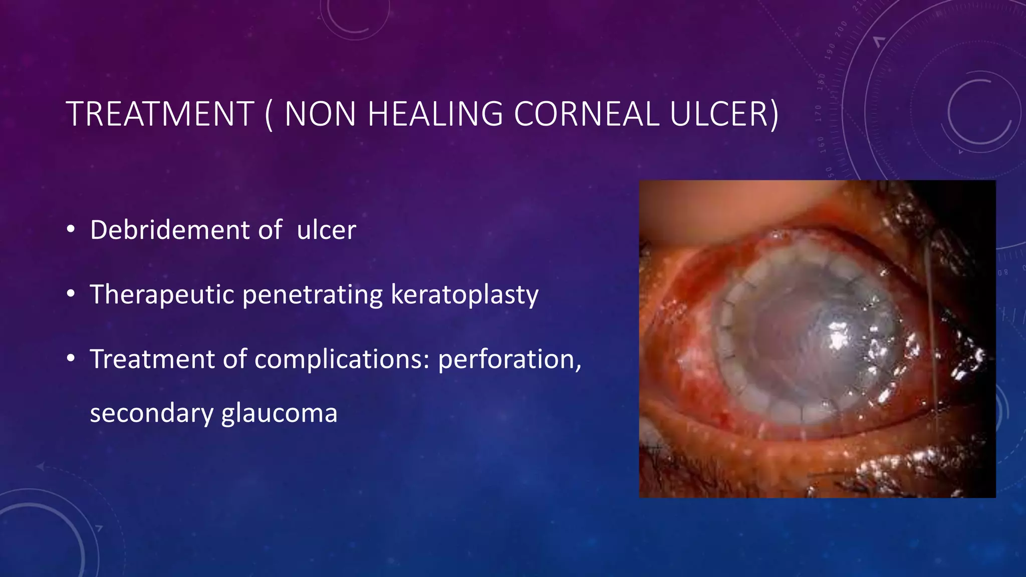 Bacterial corneal ulcers.pptx