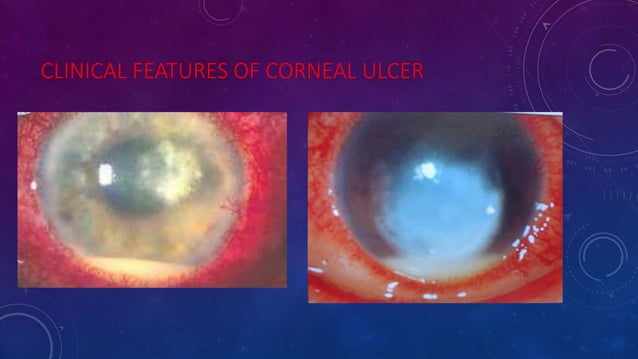 Bacterial corneal ulcers.pptx