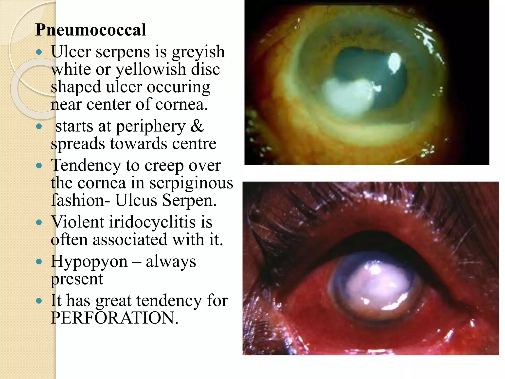 Bacterial corneal ulcer | PPTX