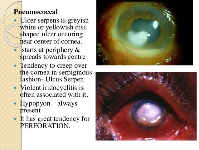 Bacterial corneal ulcer