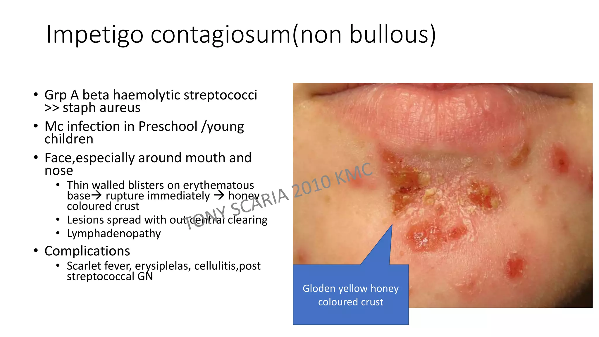 Bacterial cutaneous infection DERMATOLOGY REVISION NOTES | PDF
