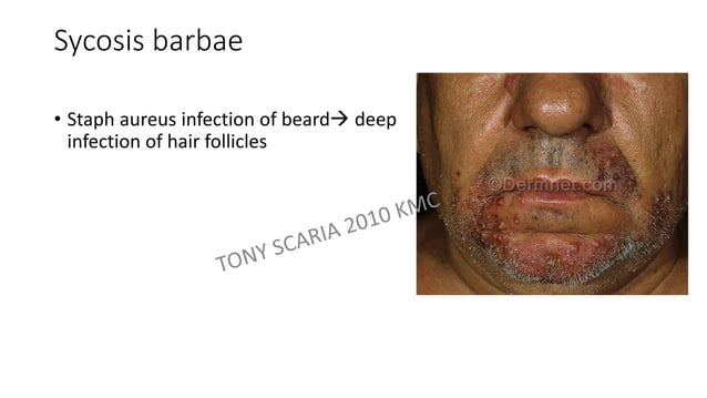 Bacterial cutaneous infection DERMATOLOGY REVISION NOTES | PDF