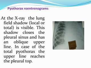 Bacterial destruction of the lungs | PPTX | Lung and Respiratory Health ...
