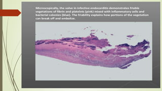 Bacterial endocarditis | PPTX