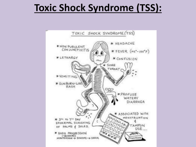 Toxic Shock Syndrome Made Extremely Easy! | PPT