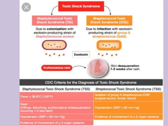 Toxic Shock Syndrome Made Extremely Easy! | PPT