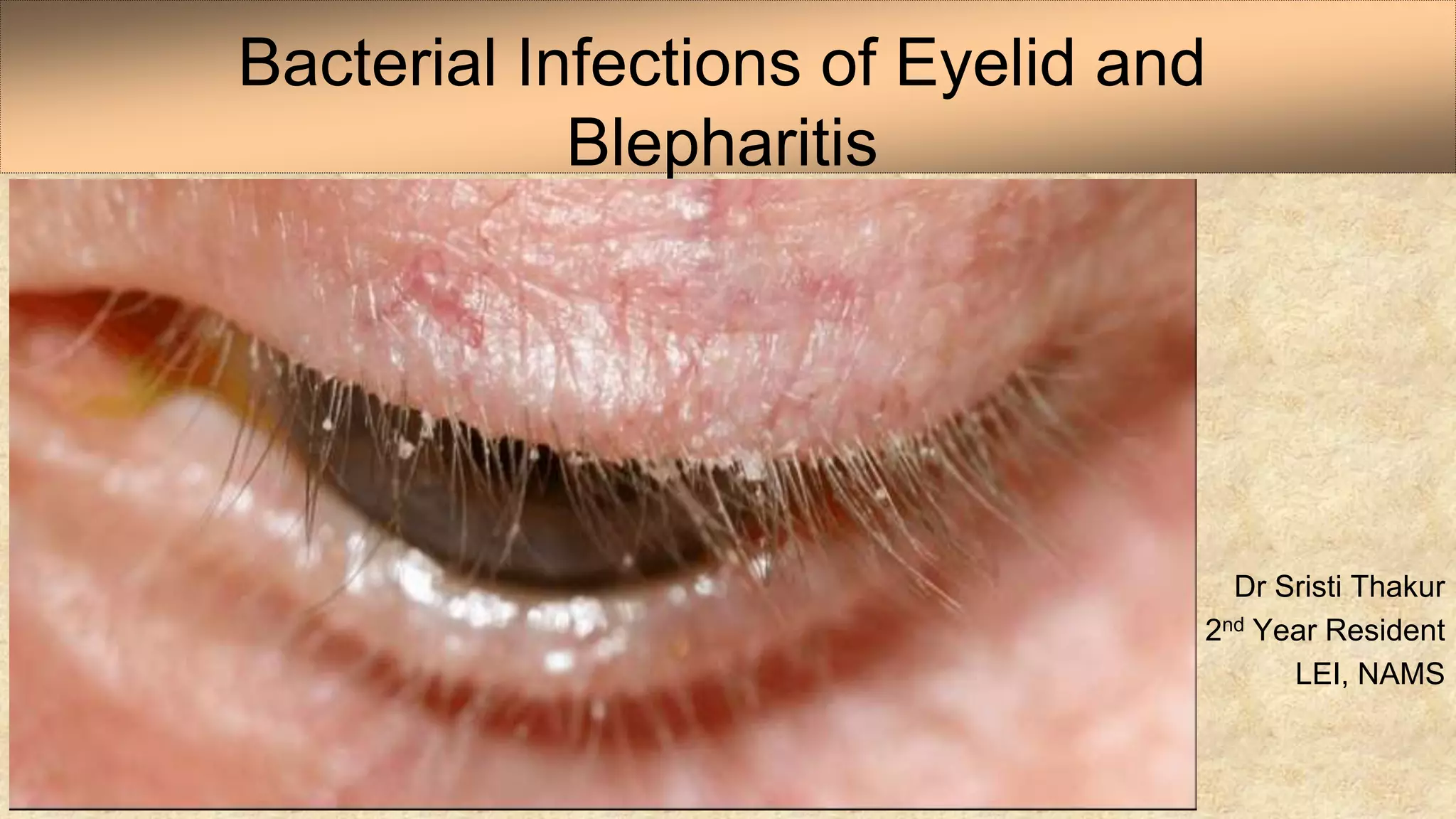 Bacterial eyelid infections and blepharitis. | PPTX