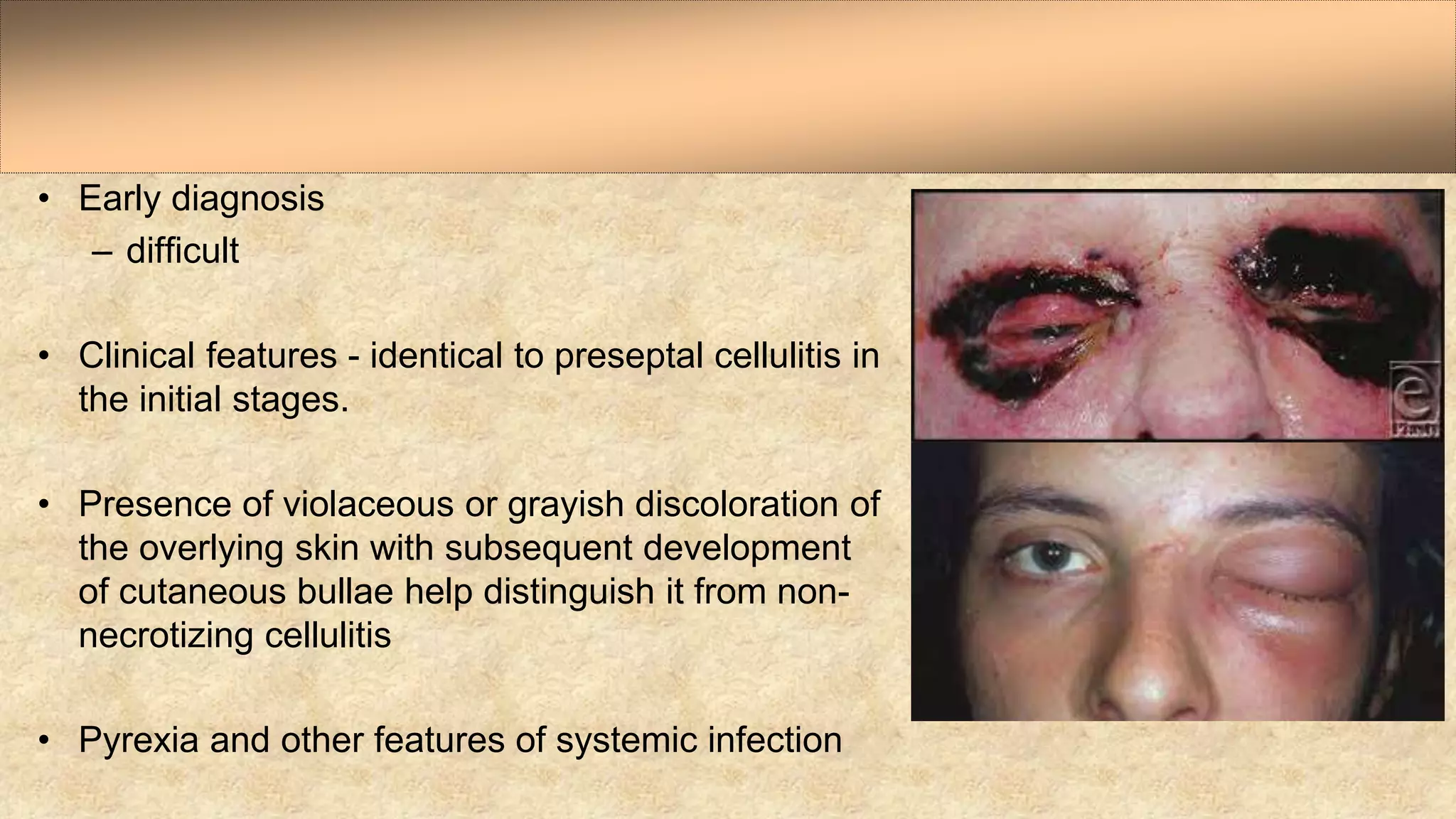 Bacterial eyelid infections and blepharitis. | PPTX
