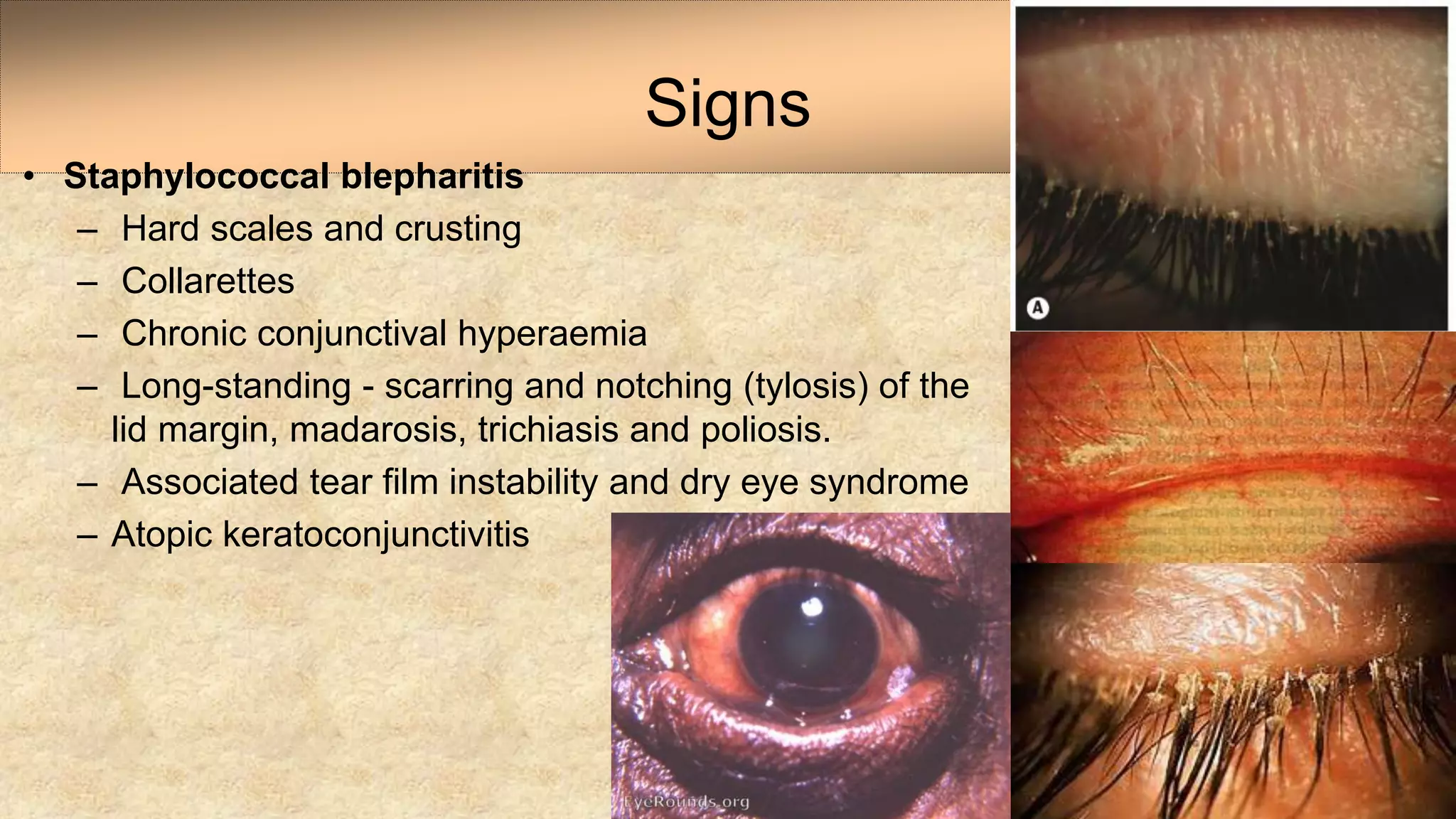 Bacterial eyelid infections and blepharitis. | PPTX